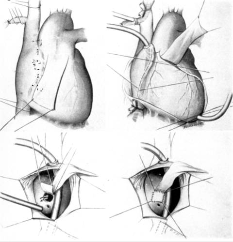 The Person Behind the Inventor of the Heart-Lung Machine: John H ...